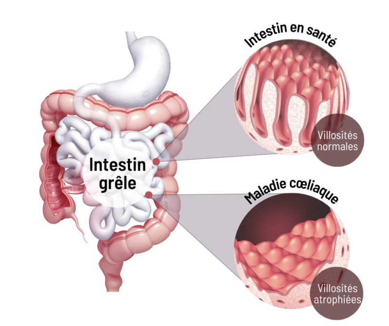 La maladie cœliaque - Simplement sans gluten